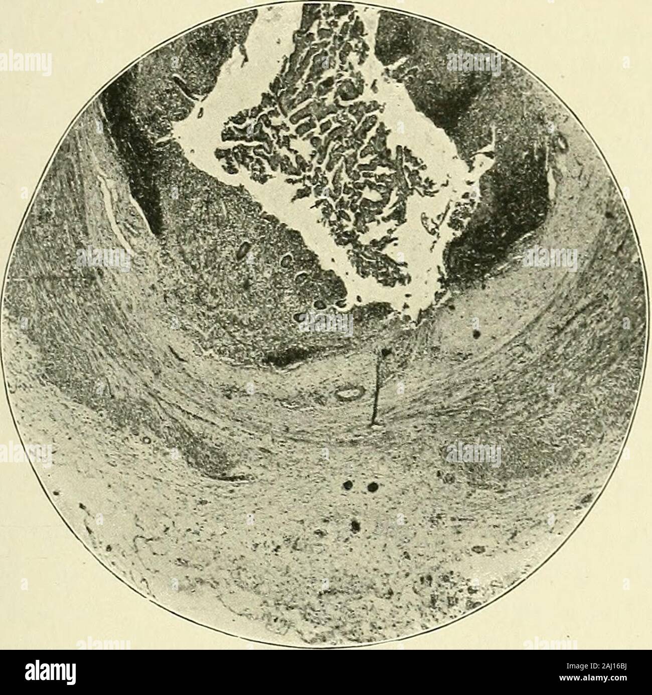 L'appendicite : sa pathologie et chirurgie . un hiatus 1 mm. de large ...