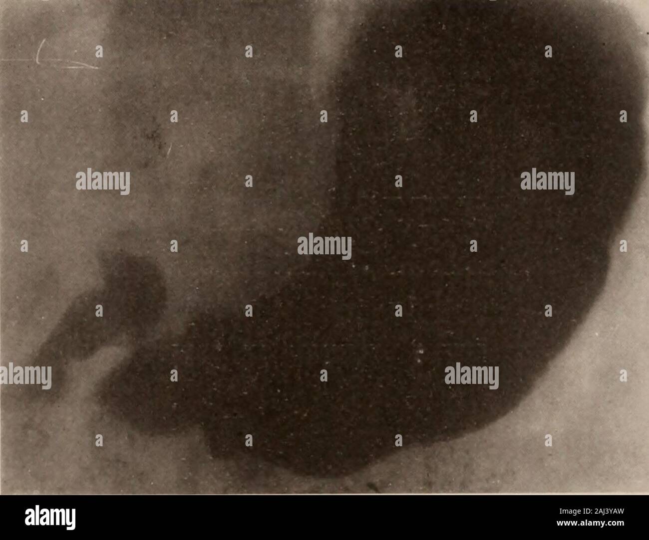 Sphincter pylorique Banque de photographies et d’images à haute ...