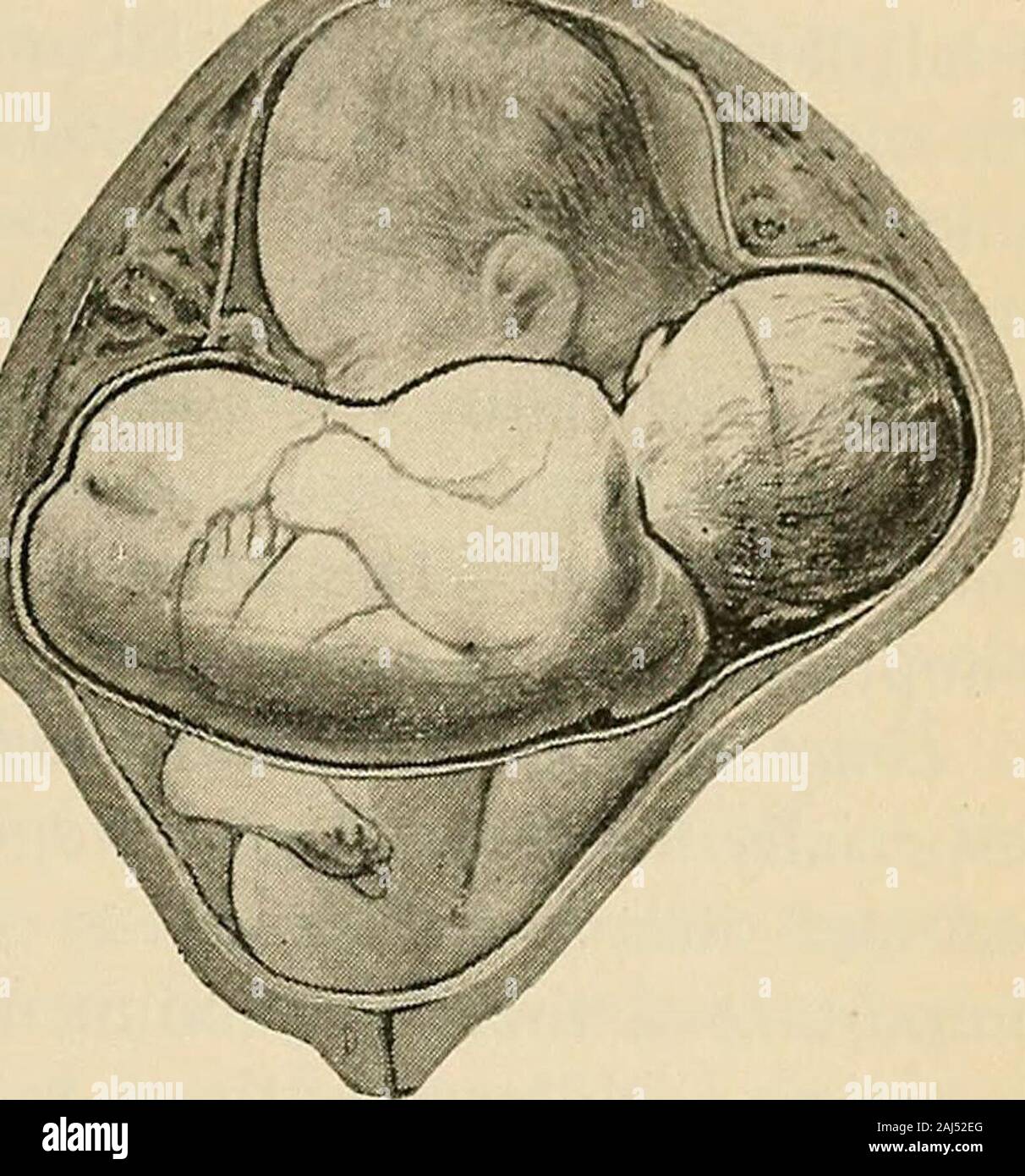 Foetus en position normale Banque de photographies et d’images à haute ...