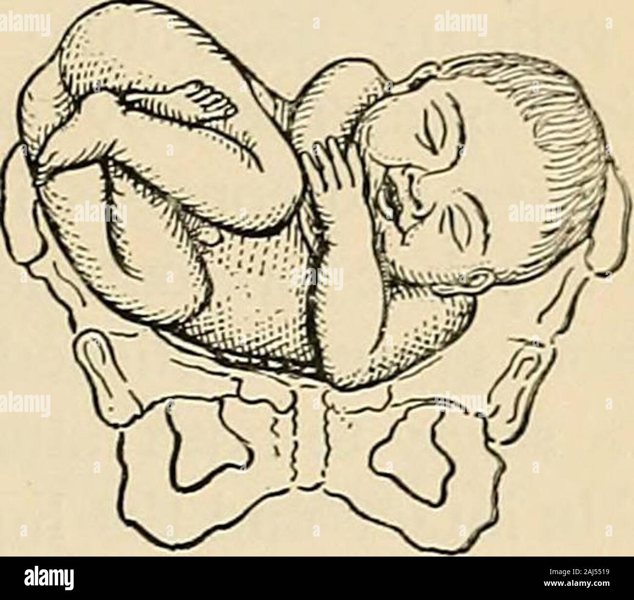 Un manuel d'obstétrique . Fig. 124.-présentation de l'Épaule,R. D. P ...