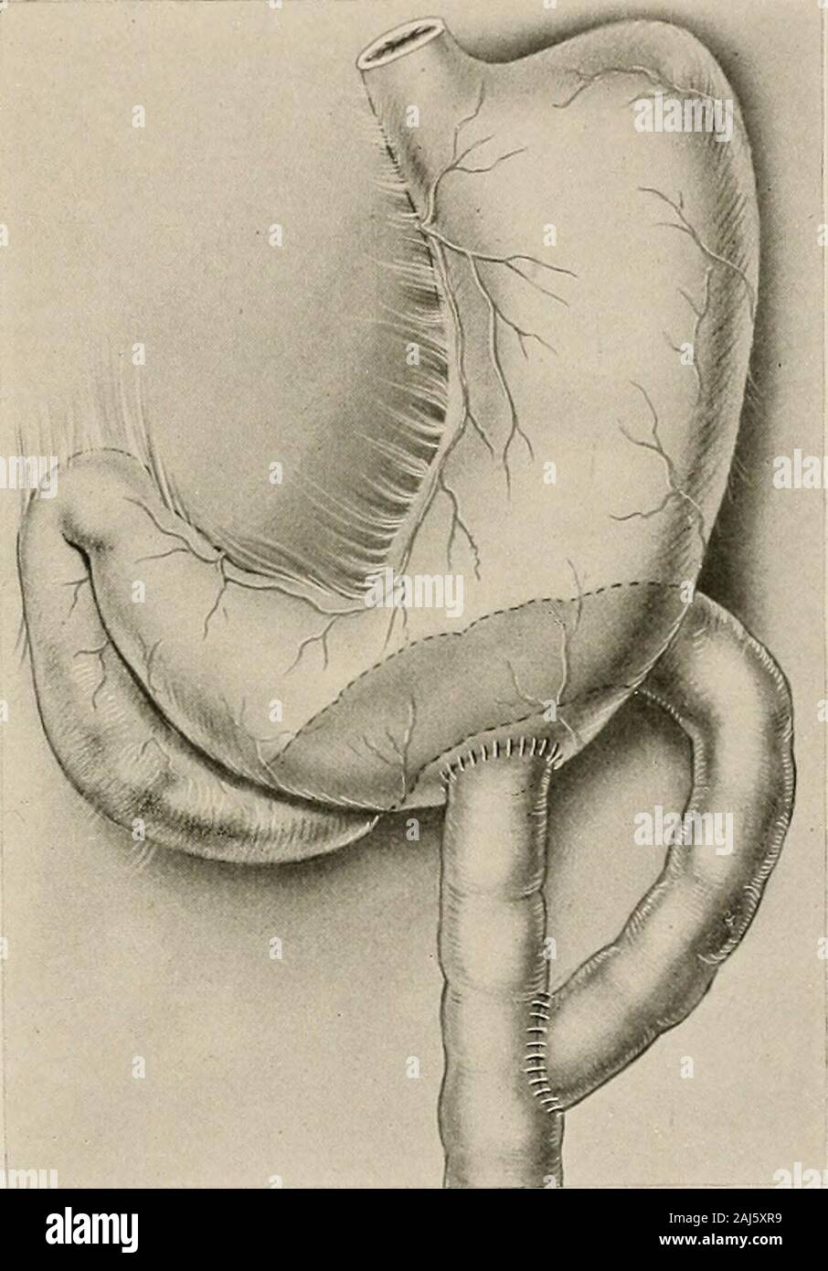 Résection intestinale Banque de photographies et d’images à haute ...