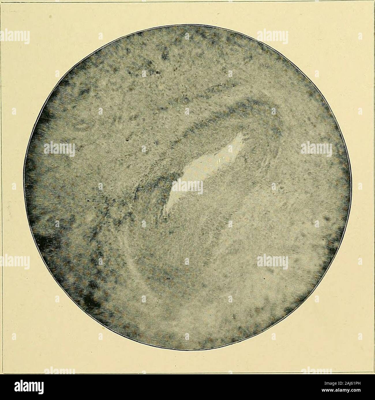 Syphilis ulcer Banque de photographies et d’images à haute résolution ...