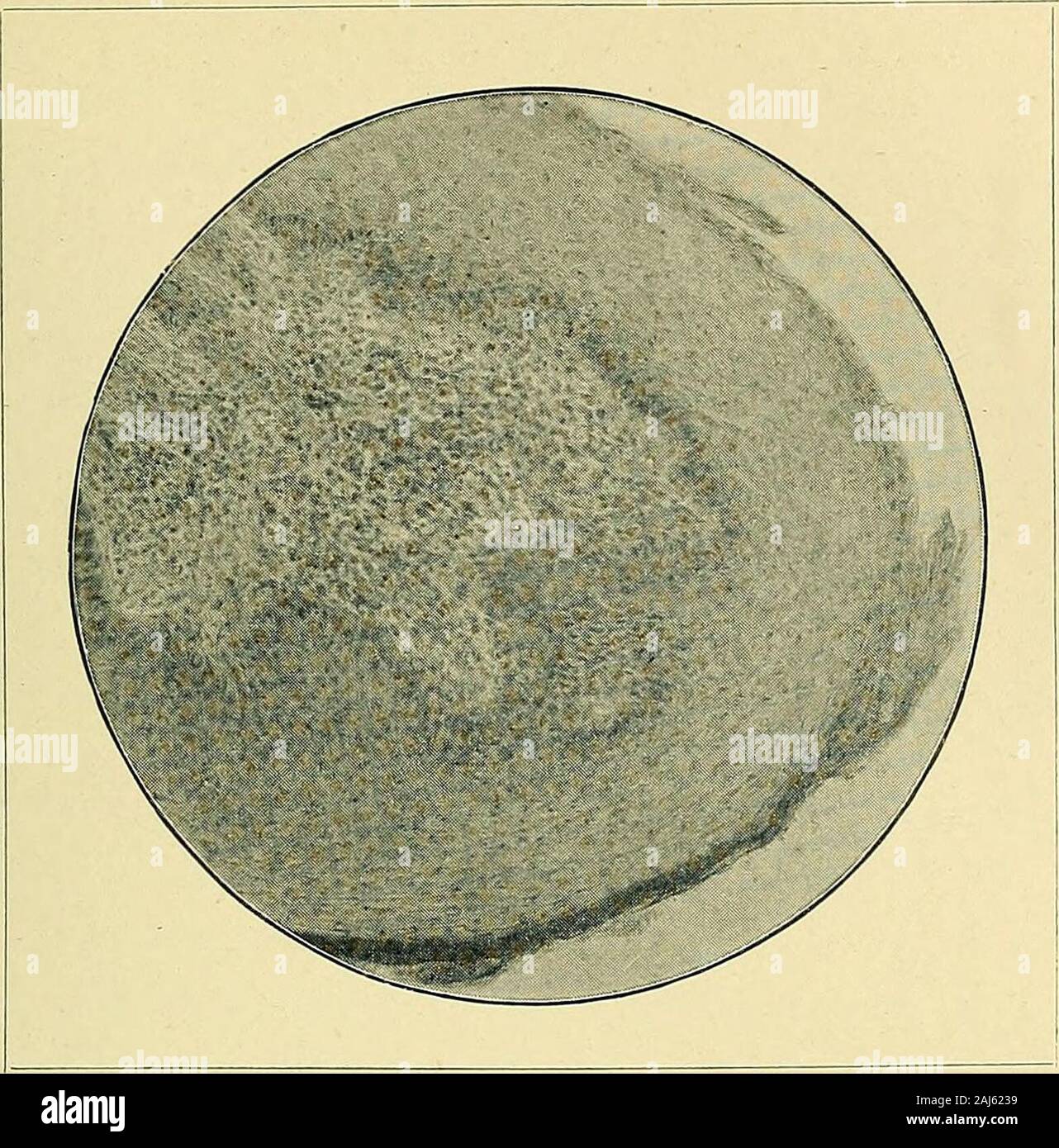 La syphilis . Gratuit^ 1. Hanliart imp EXPLICATION DE PLATE XVIII. Fig ...