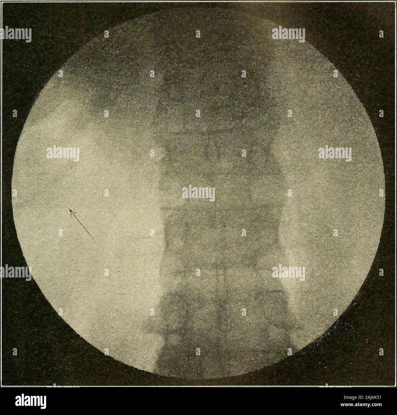 Le gynécologie : . Fig. 313.-Petite Pierre dans le bassin du rein droit ...