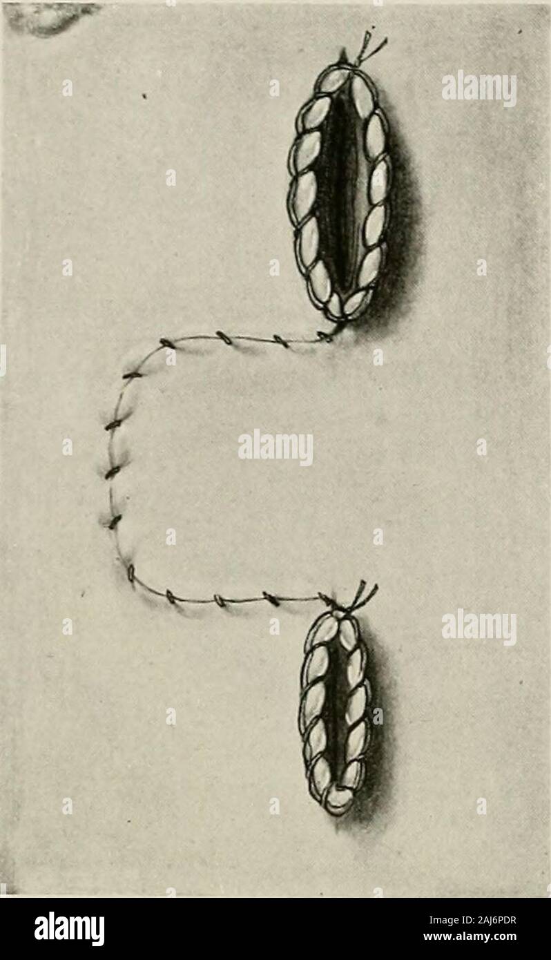 Traitement chirurgical ; un traité sur les pratiques de traitement des ...