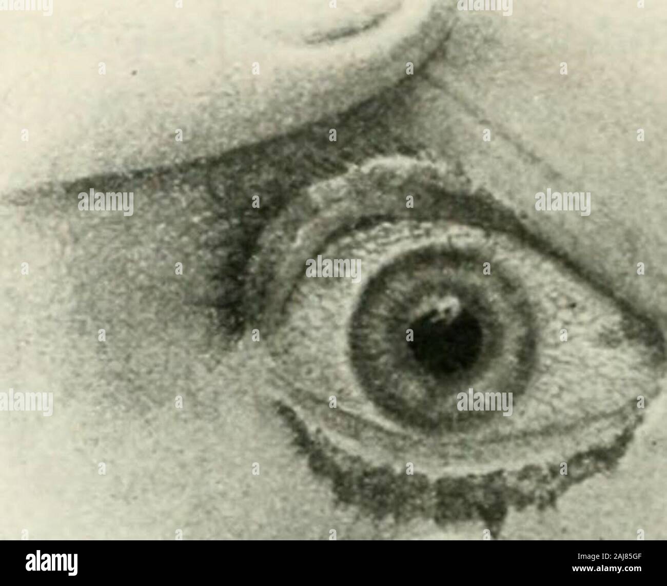 Subconjunctival hemorrhage Banque de photographies et d’images à haute ...