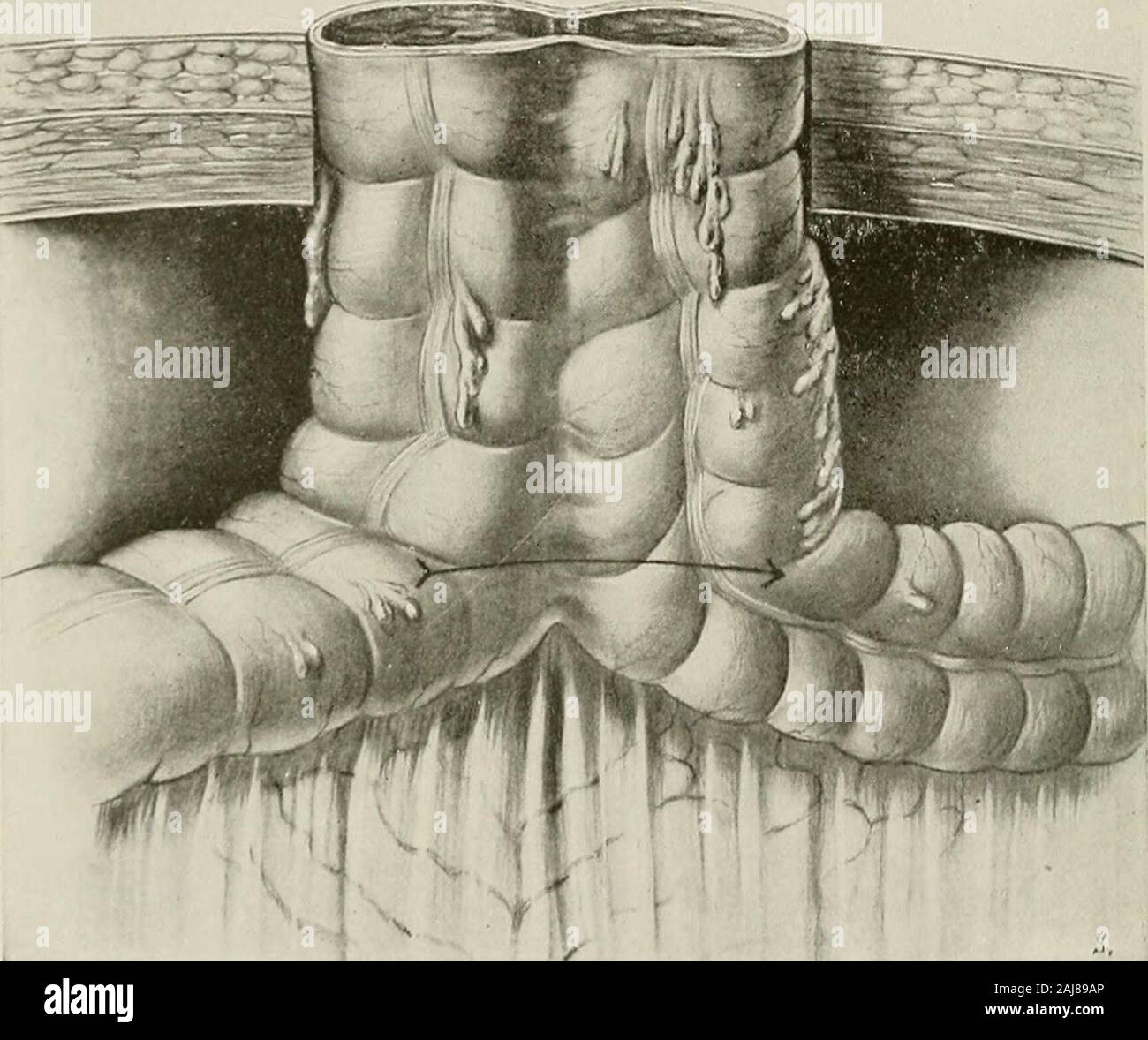 Bowel resection Banque de photographies et d’images à haute résolution ...