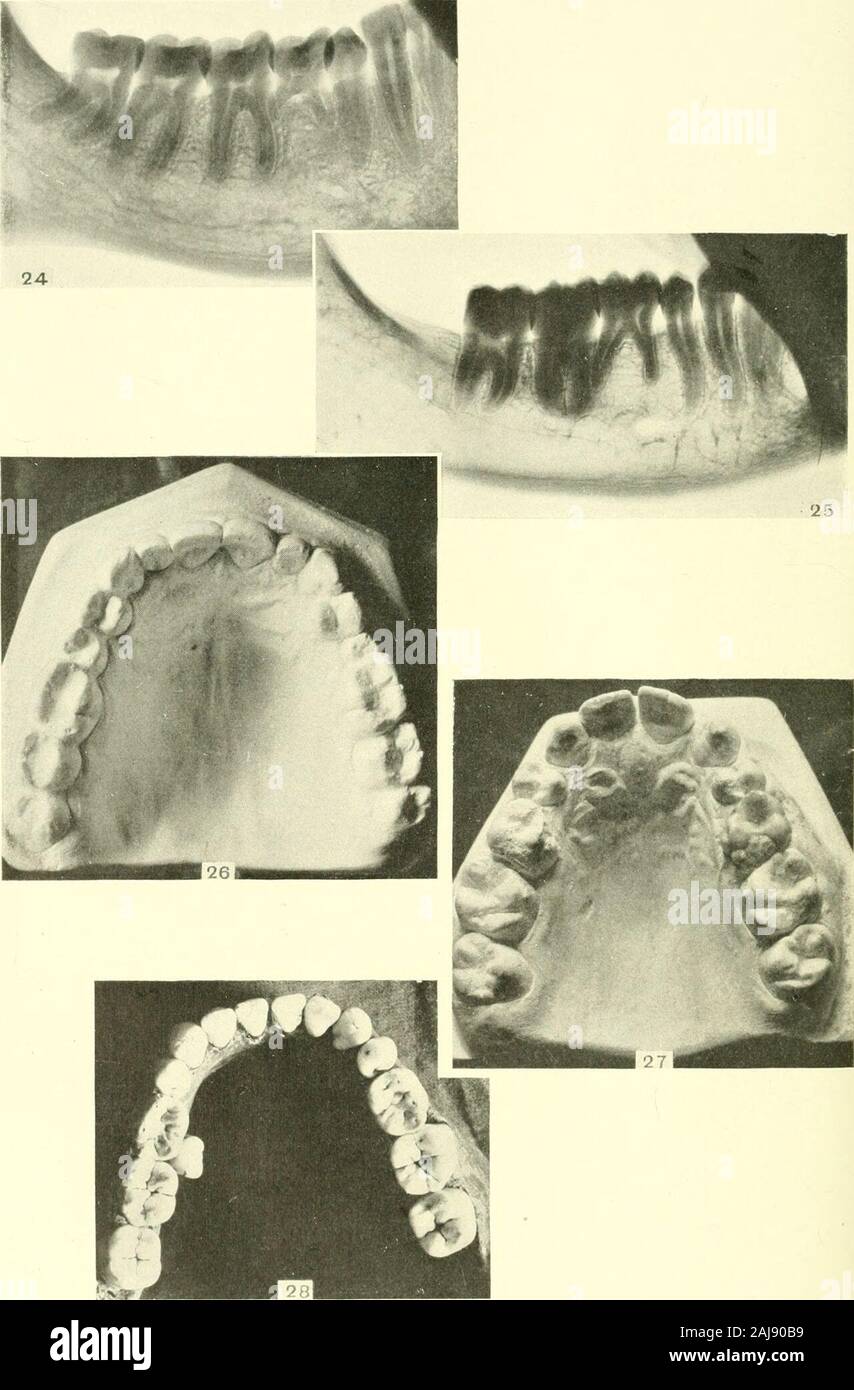 Prémolaire Banque de photographies et d’images à haute résolution - Alamy