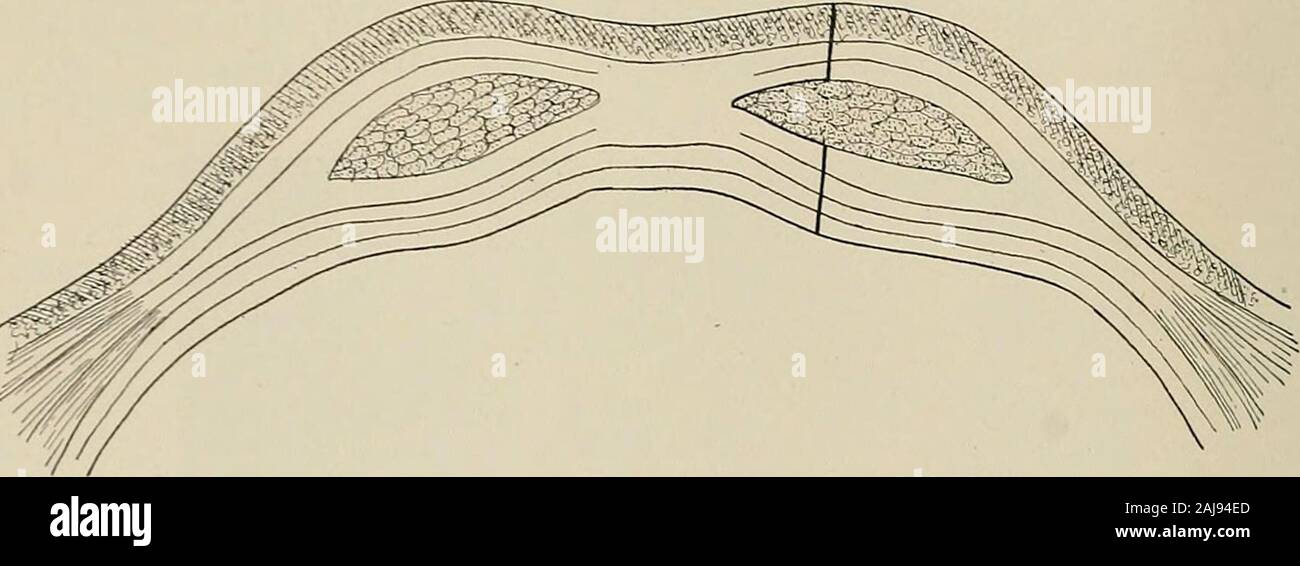 Incisiones quirurgica infraumbilical Banque de photographies et d ...