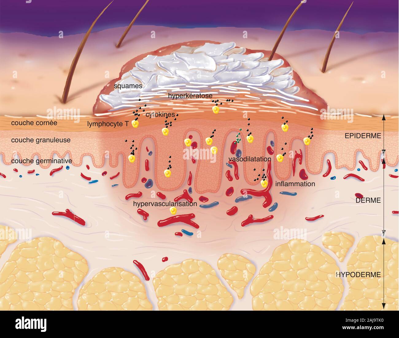 Section de peau atteinte de psoriasis Banque de photographies et d ...