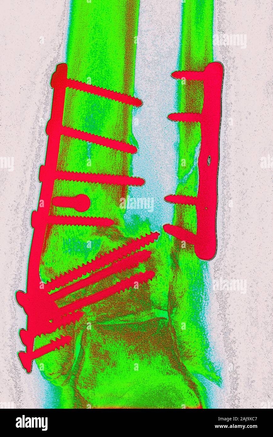 Plaque Tibiale Banque d'image et photos - Alamy