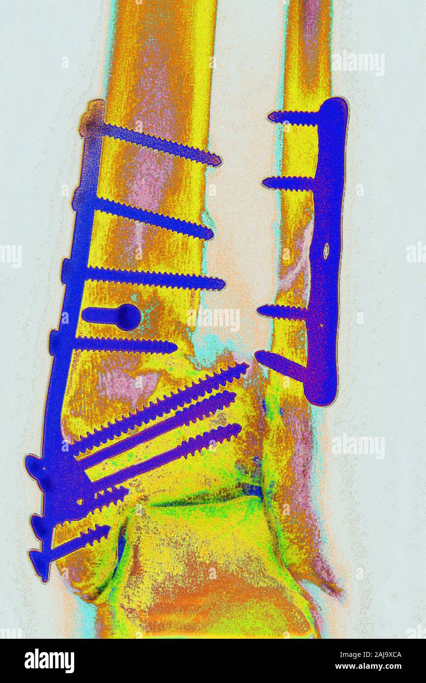 Plaque Tibiale Banque d'image et photos - Alamy