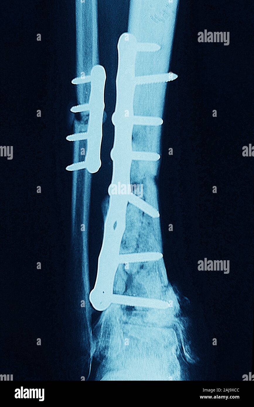 Plaque Tibiale Banque d'image et photos - Alamy