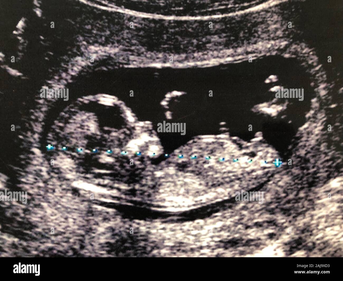 Foetus scan Banque de photographies et d’images à haute résolution - Alamy