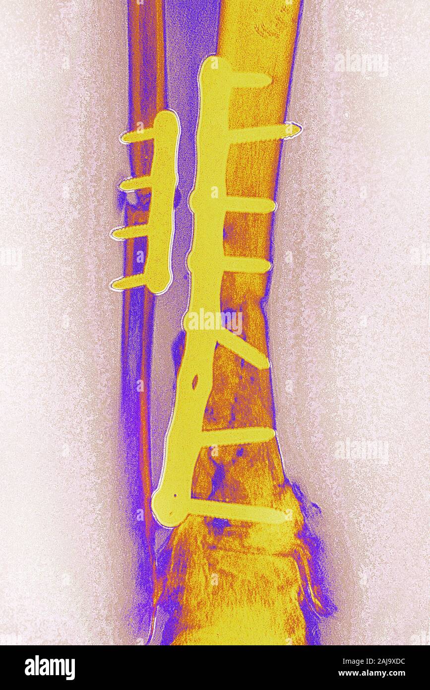 Plaque Tibiale Banque d'image et photos - Alamy