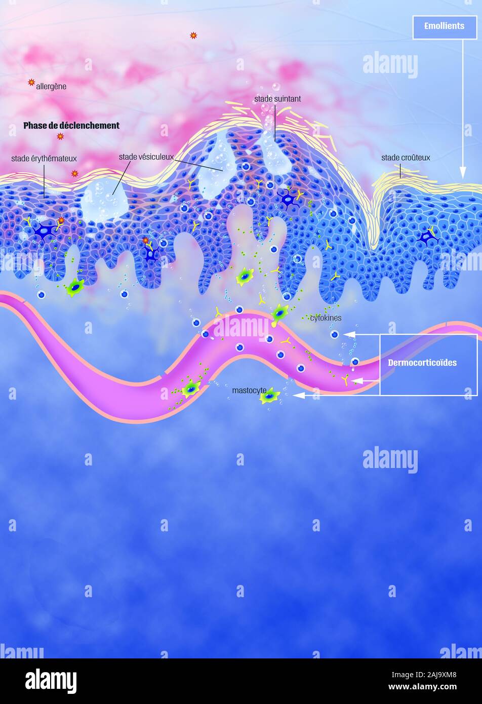 Dermatite atopique Banque de photographies et d’images à haute ...