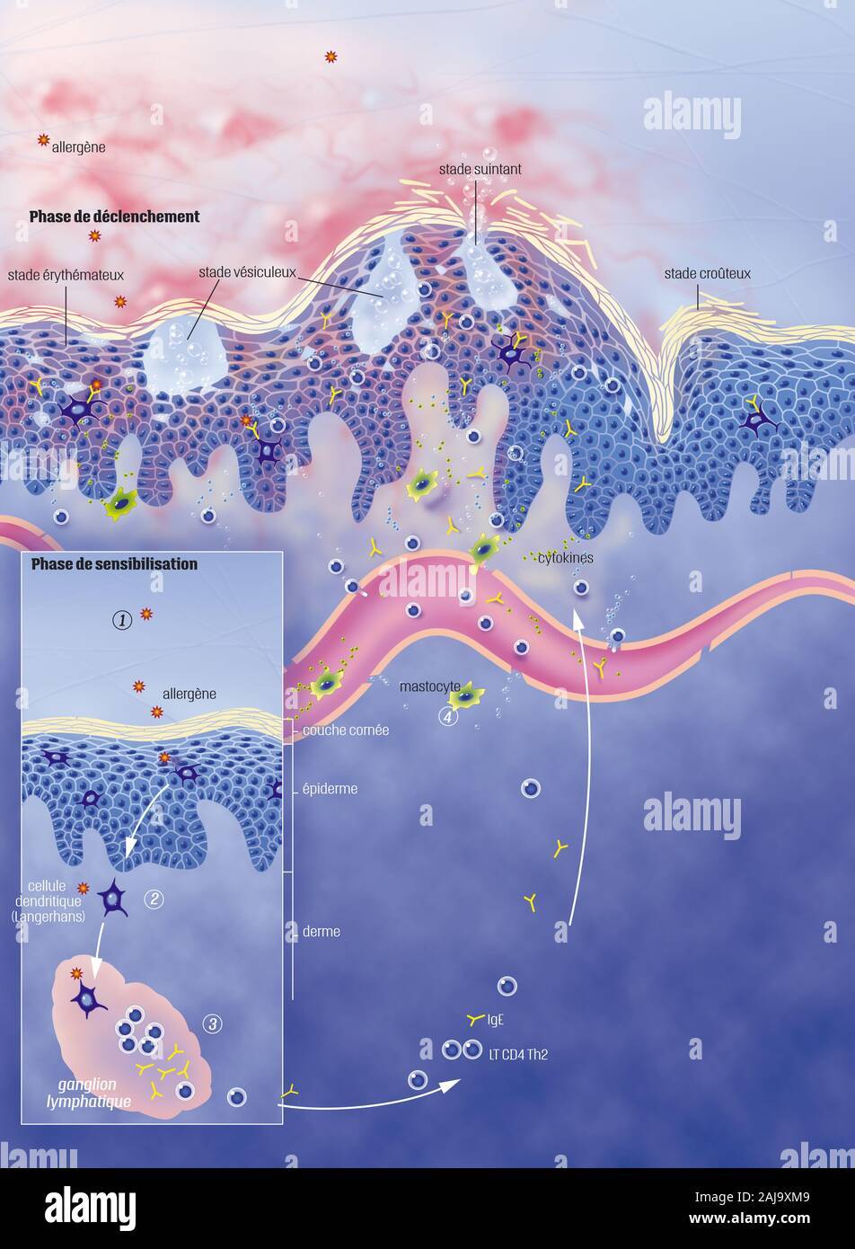 Dermatite atopique Banque de photographies et d’images à haute ...
