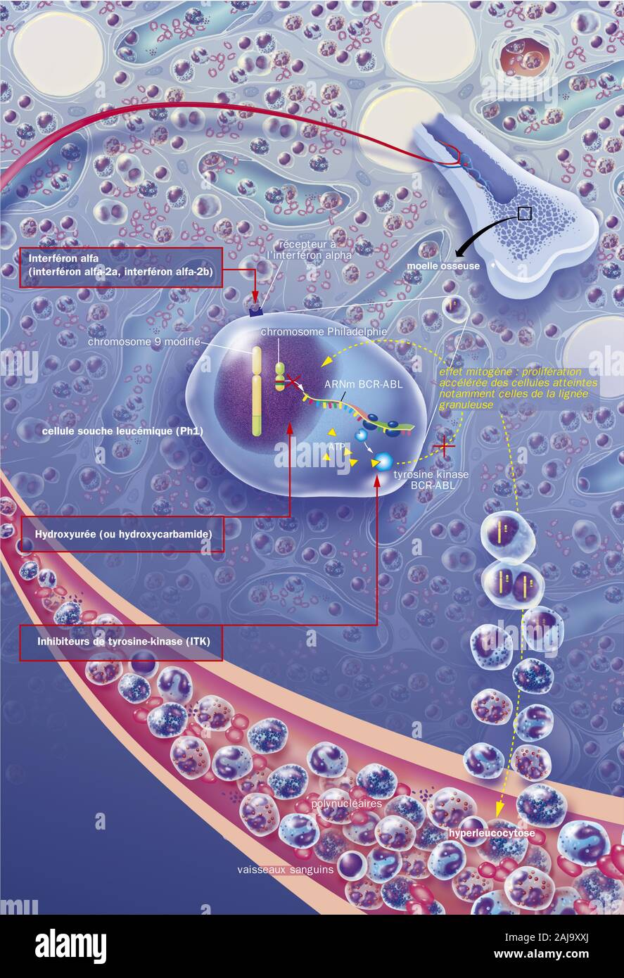 Leucémie myéloïde Banque de photographies et d’images à haute ...