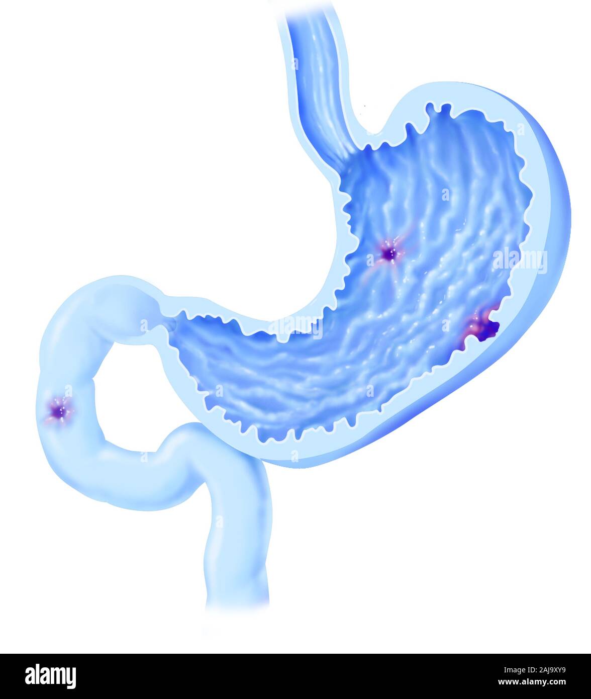 Ulcere gastrique Banque d'images détourées - Alamy