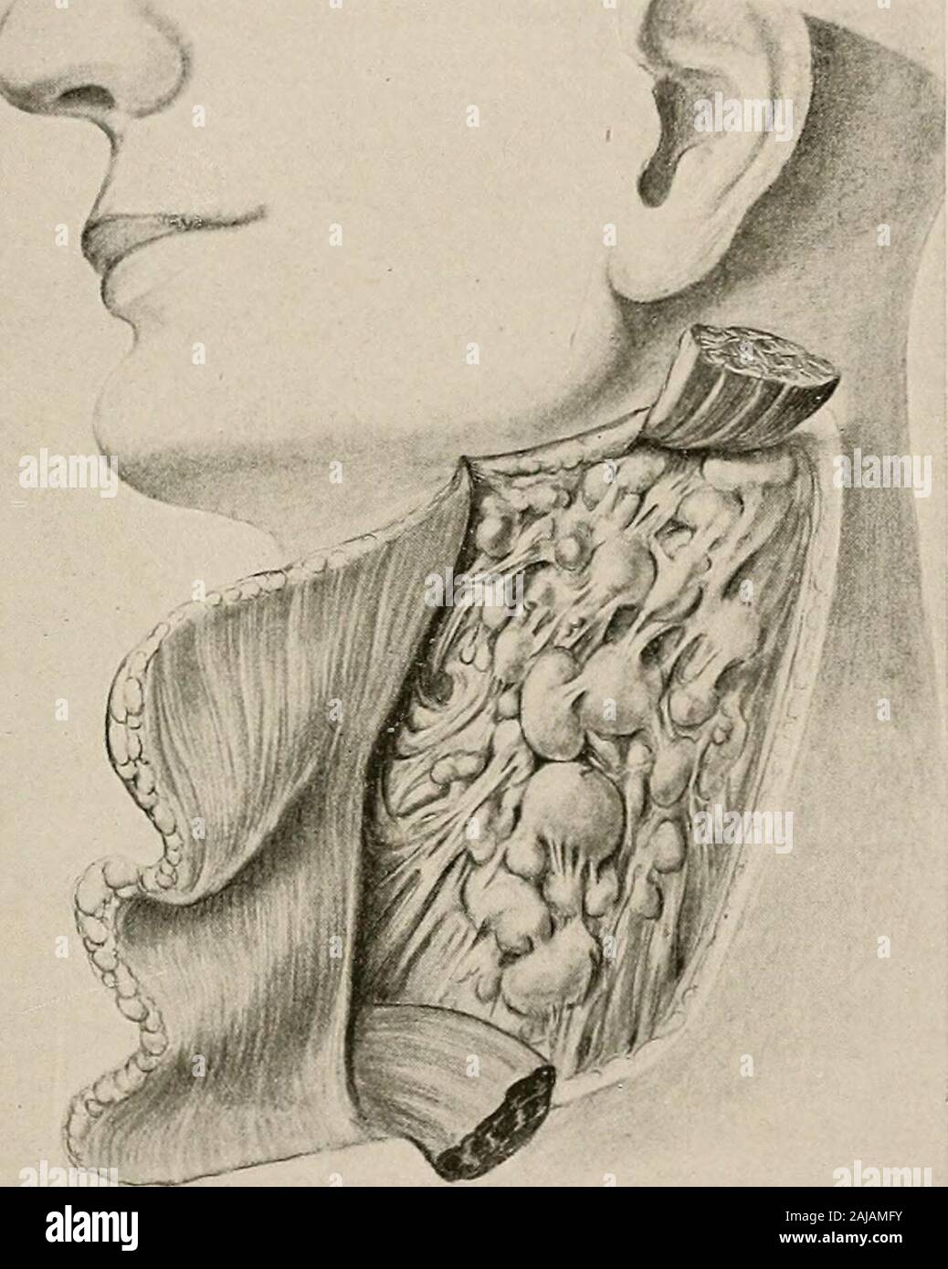 Supra clavicular incision Banque de photographies et d’images à haute ...