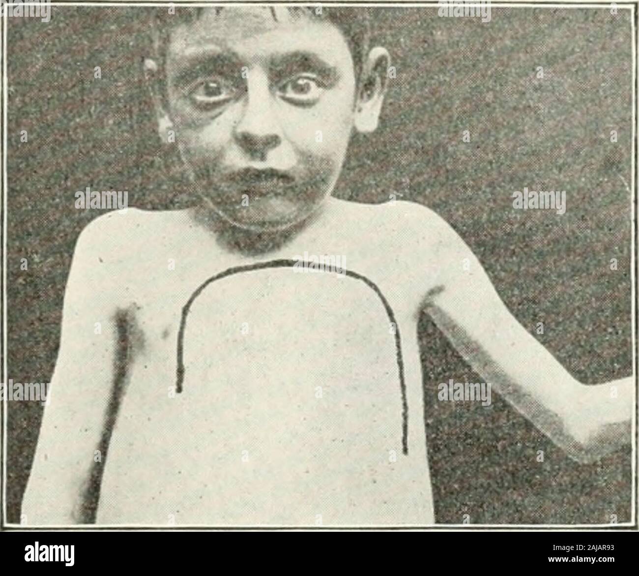 Insuffisance valvulaire mitrale Banque de photographies et d’images à ...