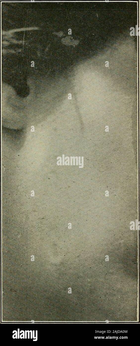 Cicatrice d'excision Banque de photographies et d’images à haute ...