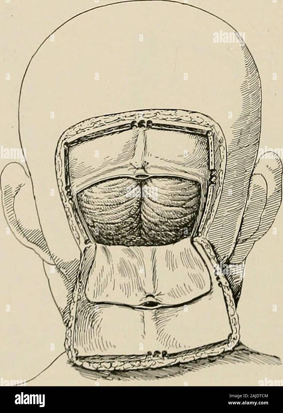 Craniotomie avec moteur Banque de photographies et d’images à haute ...