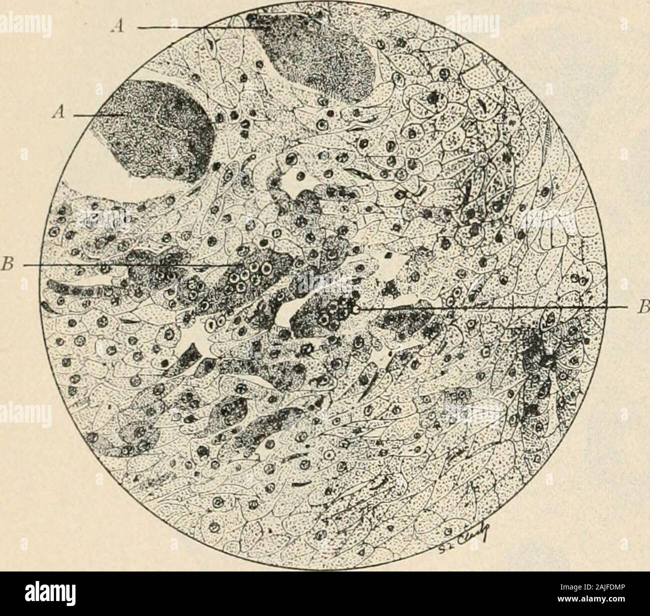 Abcès froid Banque de photographies et d’images à haute résolution - Alamy