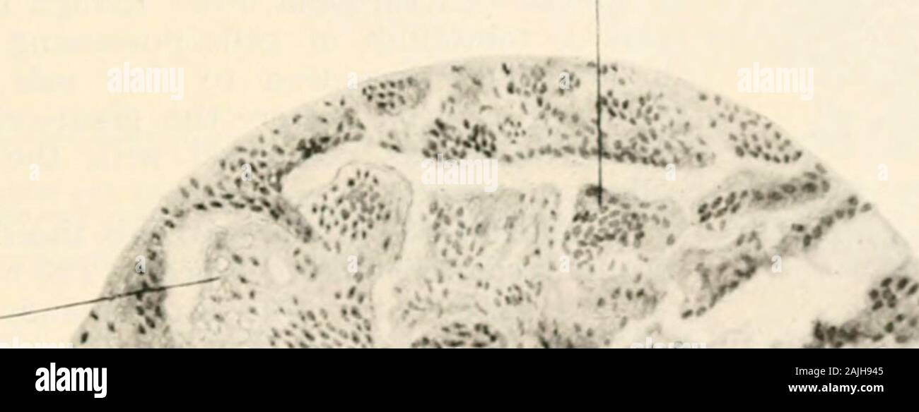 Tumeurs à cellules fusiformes Banque de photographies et d’images à ...