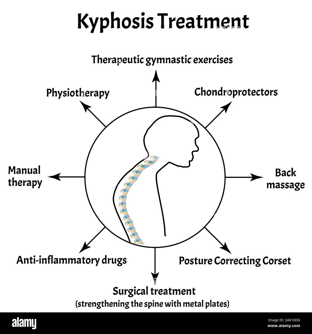 Traitement de la cyphose. La courbure de la colonne vertébrale, la ...
