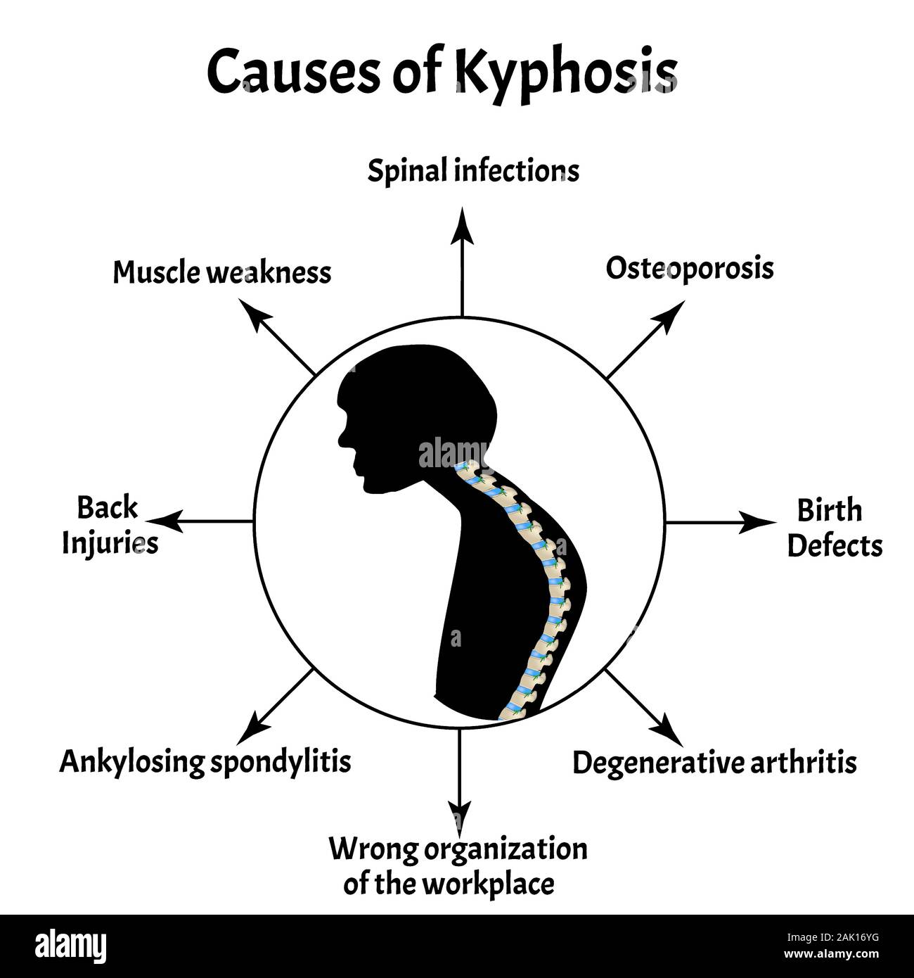 Causes de la cyphose. La courbure de la colonne vertébrale, la scoliose ...