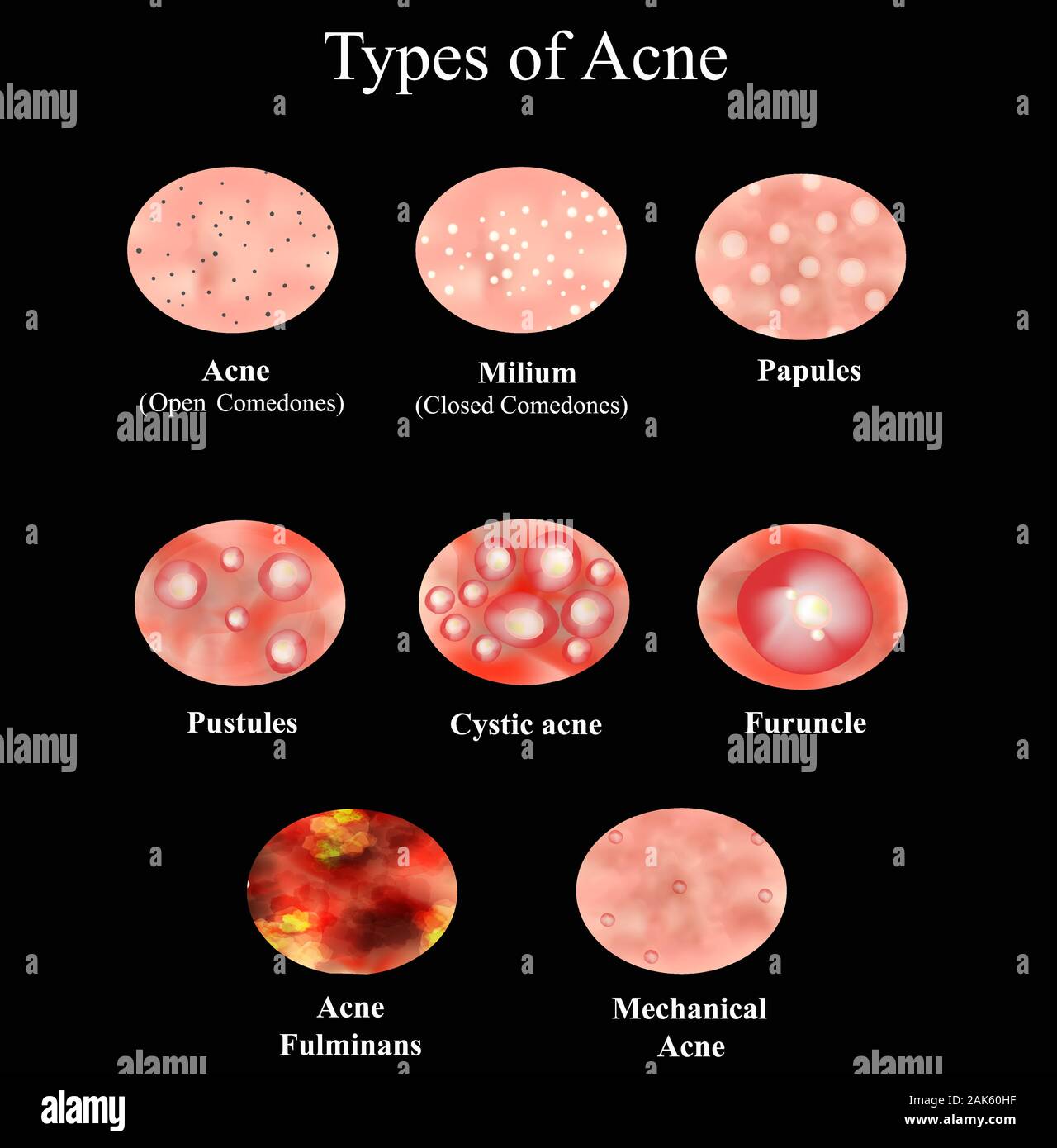 Types d'Acné inflammation de la peau. Boutons, furoncles, Whitehead ...