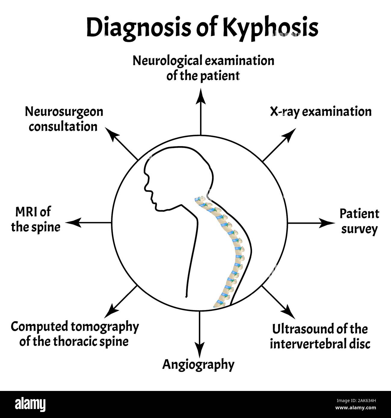 Diagnostic de la cyphose. La courbure de la colonne vertébrale, la ...