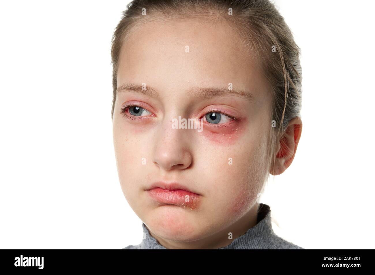 Réaction allergique, éruption de peau, fermer la vue portrait d'un ...