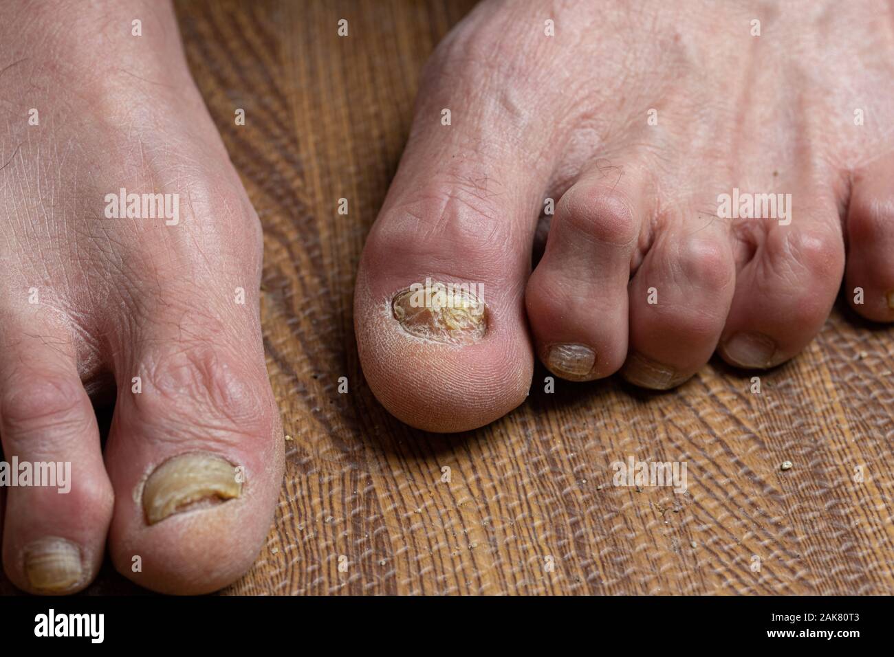 Orteil de champignon Banque de photographies et d’images à haute ...