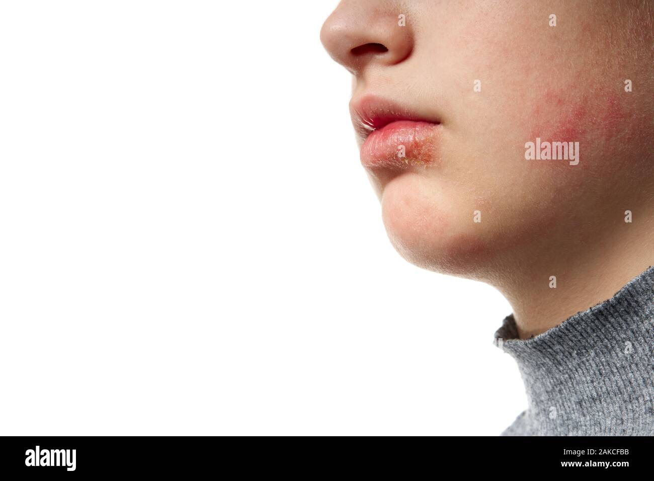Réaction allergique, éruption de peau, fermer la vue portrait d'un ...