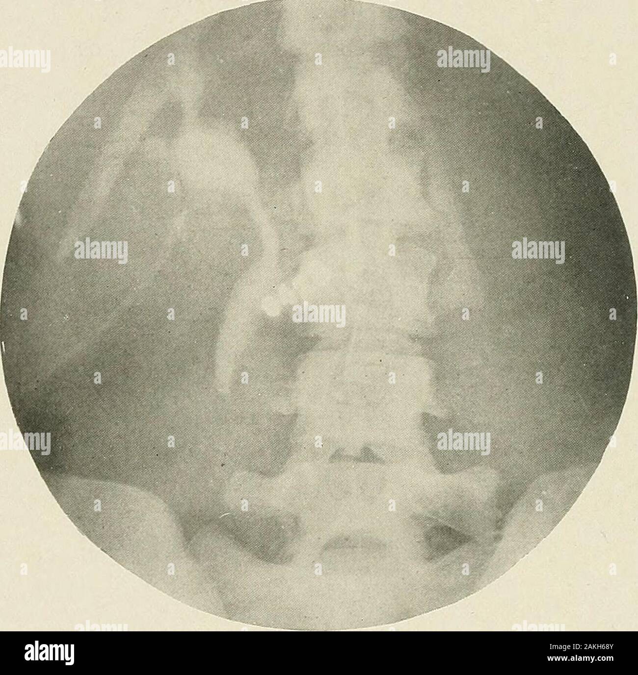 (Pyelo-ureterography La pyélographie) une étude de l'anatomie normale ...
