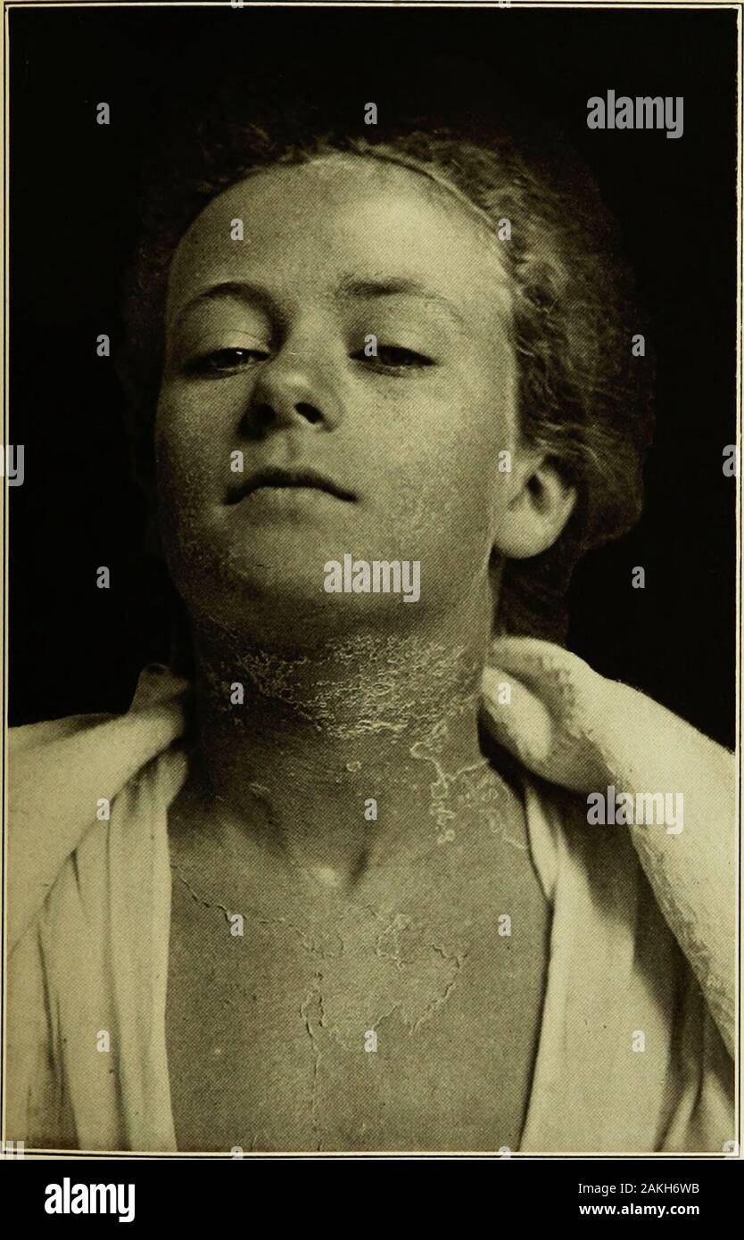 éruption de scarlatine Banque de photographies et d’images à haute ...