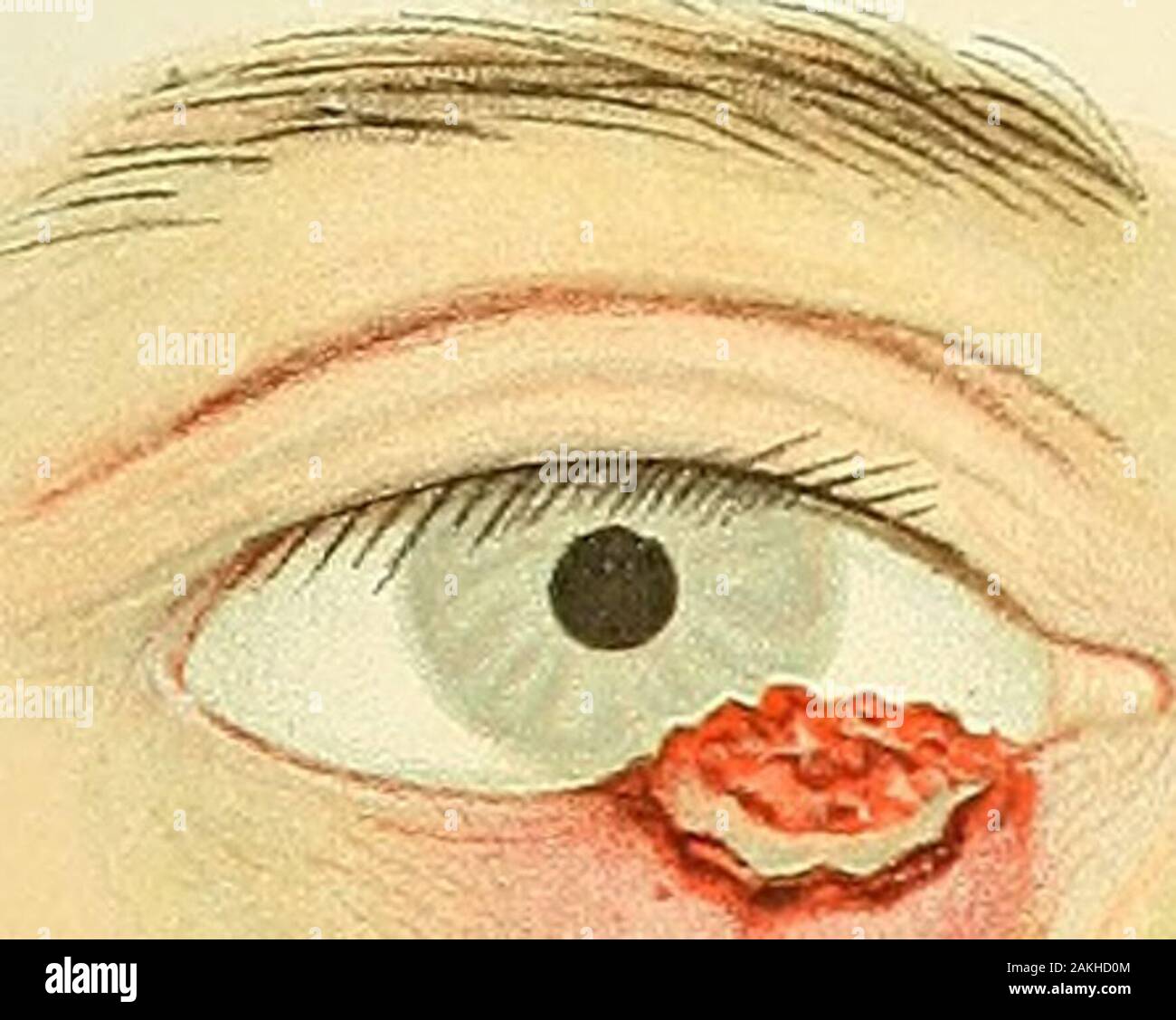 Syphilis chancre Banque de photographies et d’images à haute résolution ...