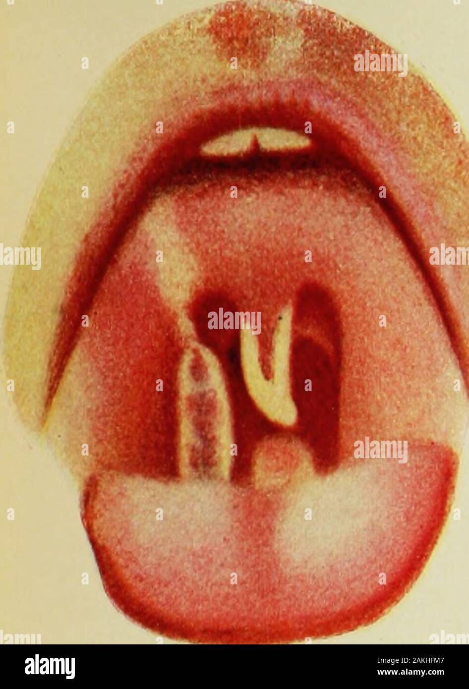 Tonsils posterior Banque de photographies et d’images à haute ...