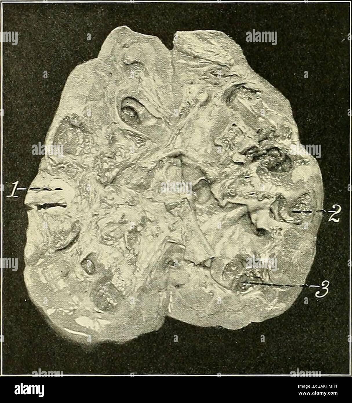 Nécrose cutanée Banque de photographies et d’images à haute résolution ...