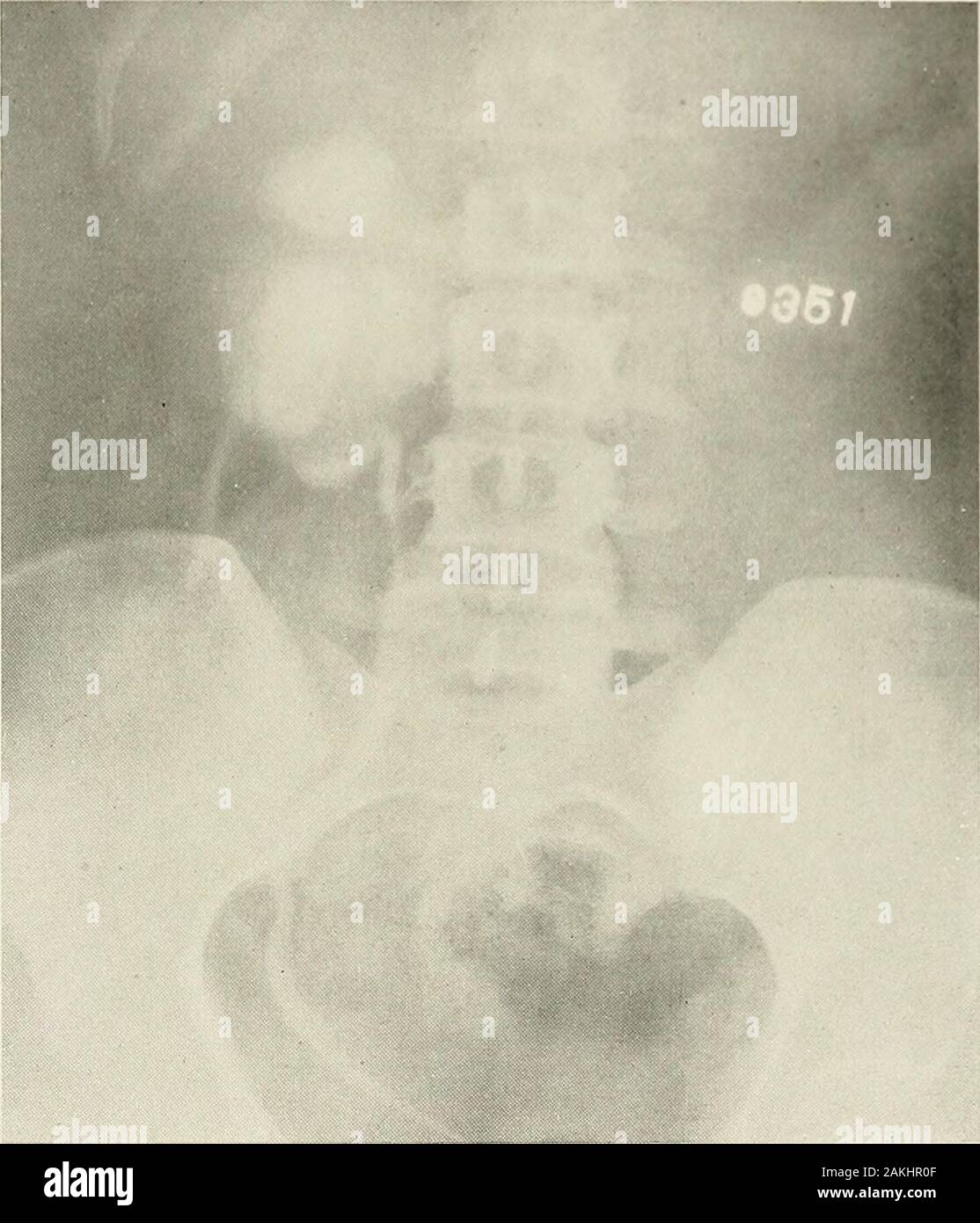 (Pyelo-ureterography La pyélographie) une étude de l'anatomie normale ...