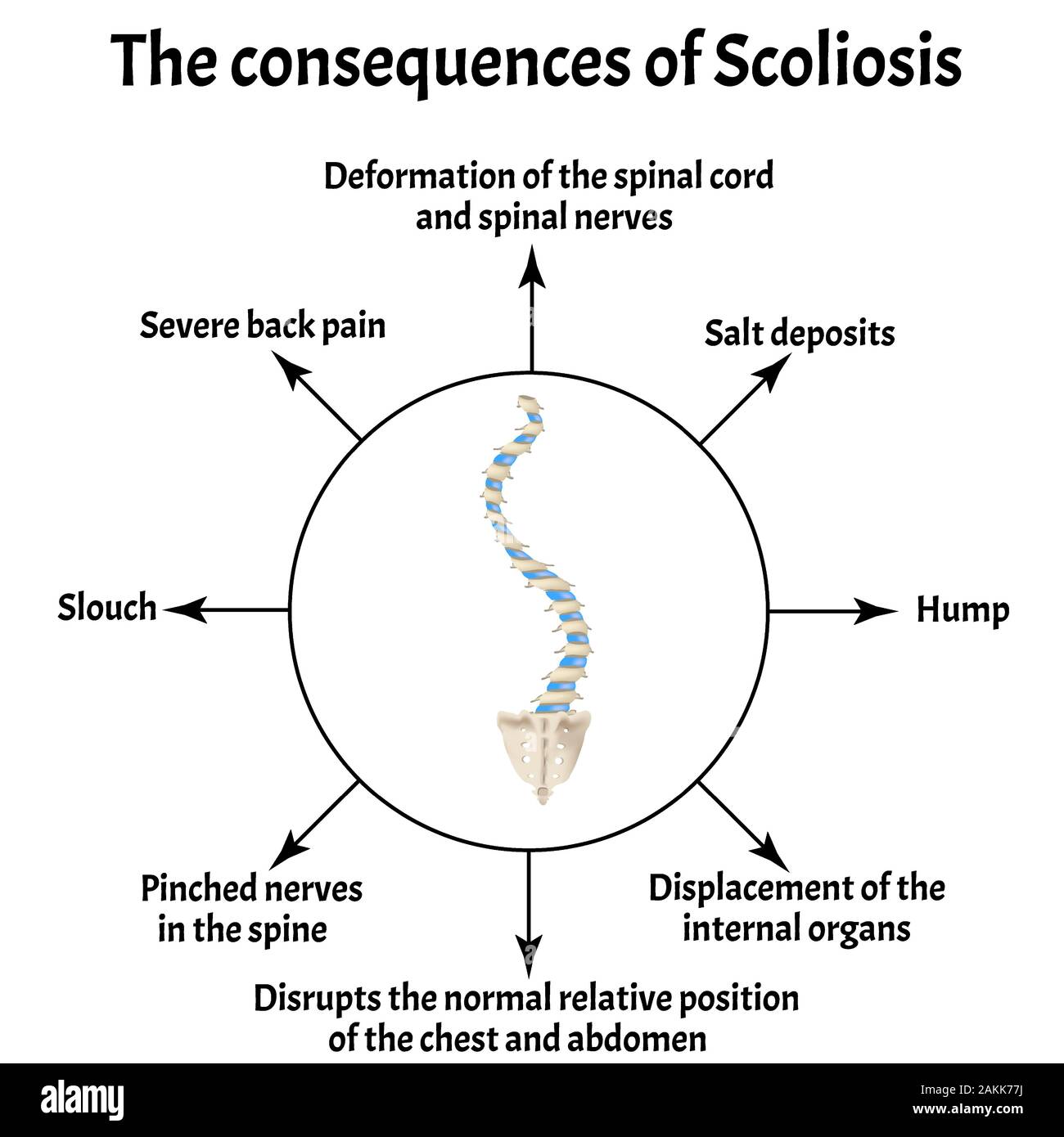 Les conséquences d'une scoliose. La courbure de la colonne vertébrale ...