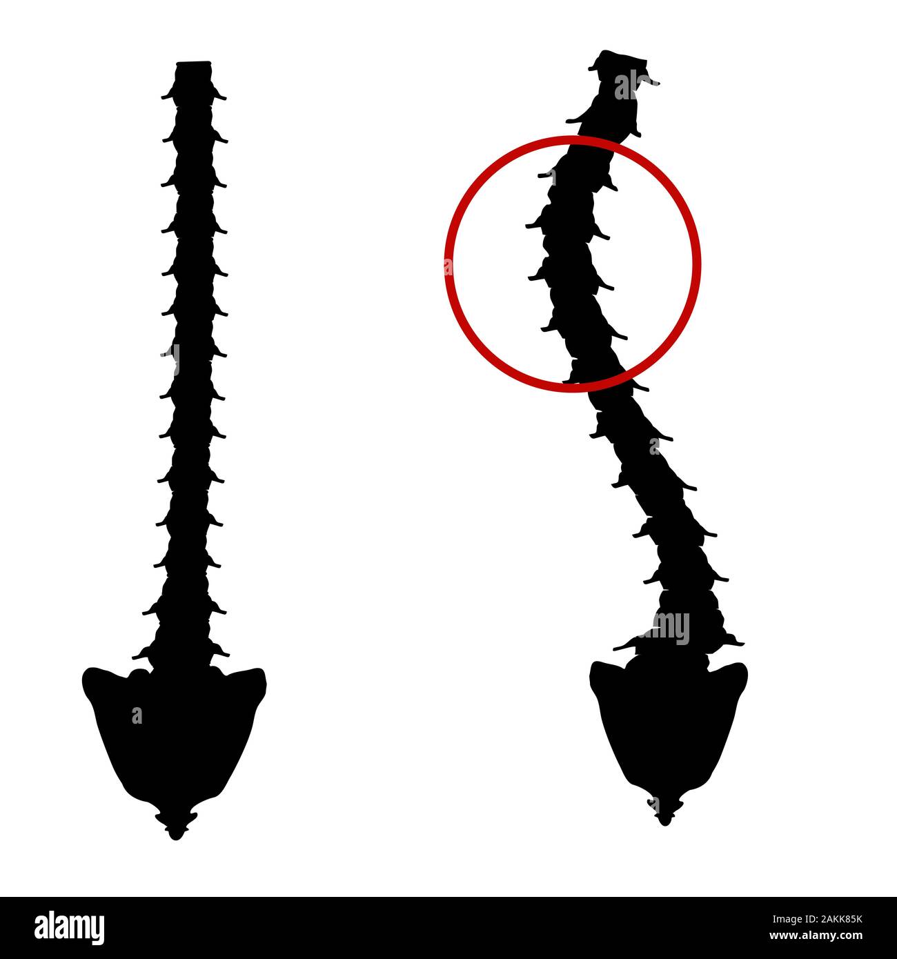 Icône silhouette noir et blanc la scoliose. La courbure de la colonne ...