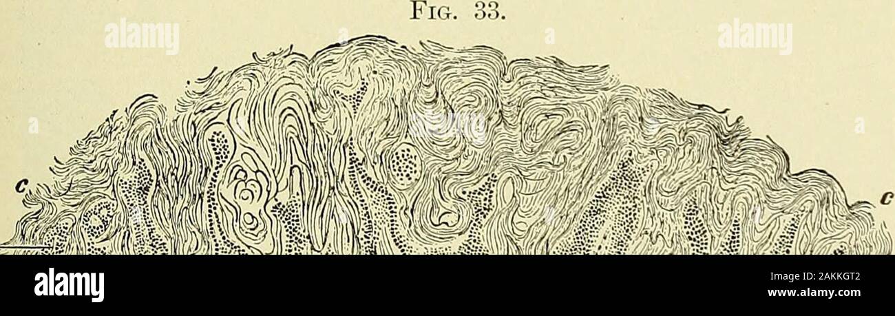 Tumeurs à cellules fusiformes Banque de photographies et d’images à ...