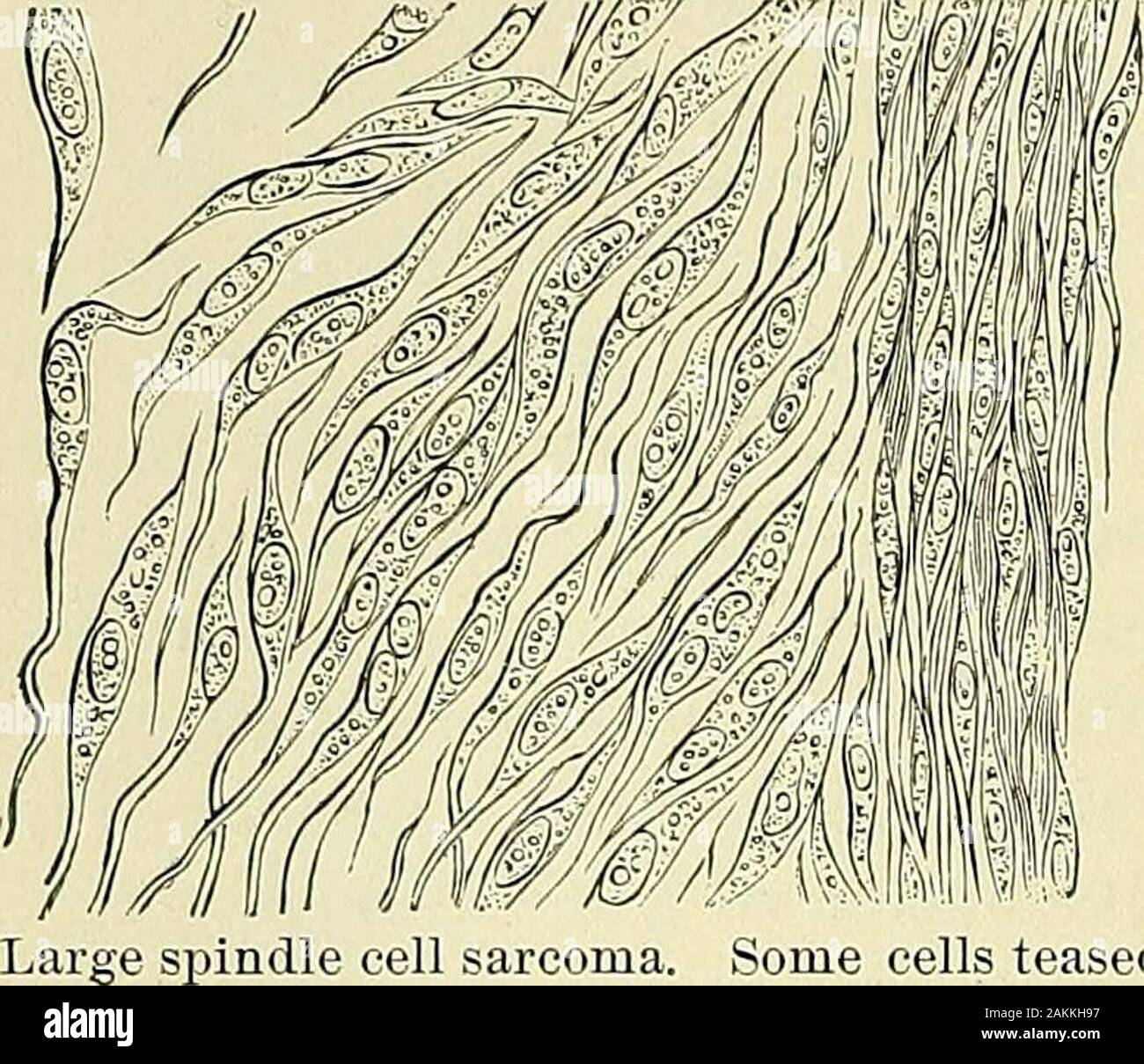 Tumeurs à cellules fusiformes Banque de photographies et d’images à ...