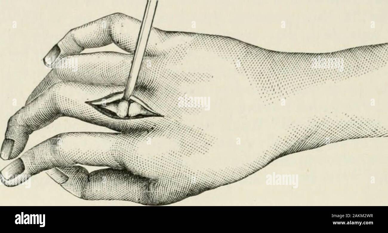Metacarpo phalangeal joint Banque de photographies et d’images à haute ...