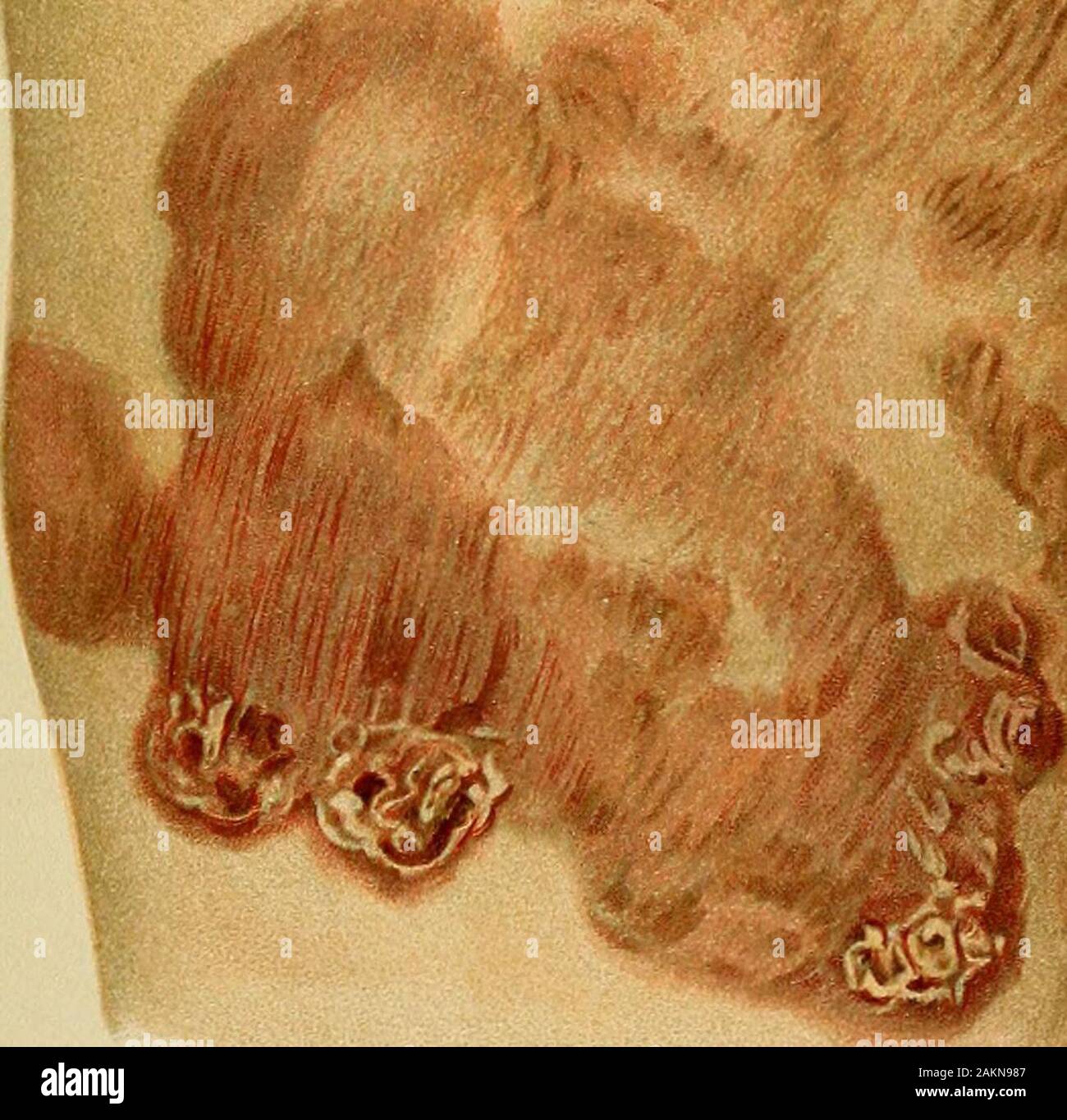 Syphilis gommeuse Banque de photographies et d’images à haute ...