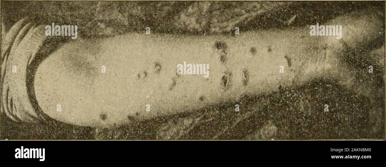 4 pustules Banque de photographies et d’images à haute résolution - Alamy