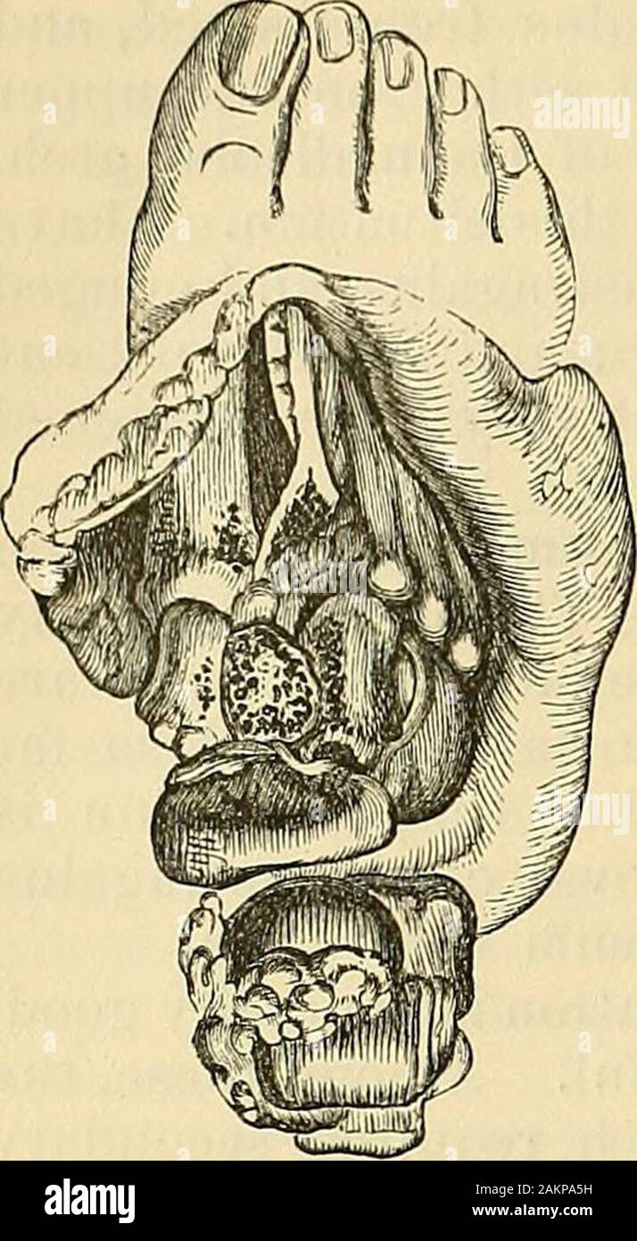 Amputation choparts Banque de photographies et d’images à haute ...